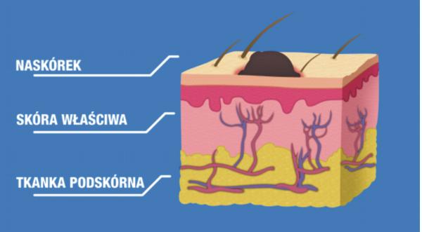 Czerniak - co to za nowotwór, jakie są objawy, jak mu zapobiegać i jak ...